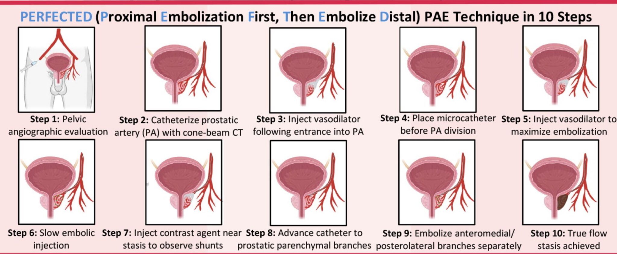Benign Prostatic Hyperplasia - Pinellas Vascular