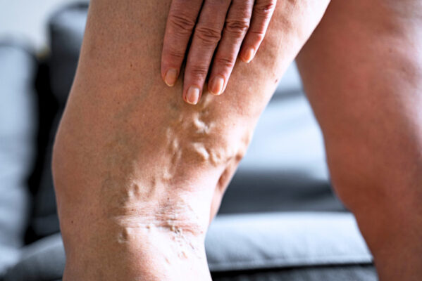 Varicose Vein Treatment Tampa | Expert Vein Care Solutions