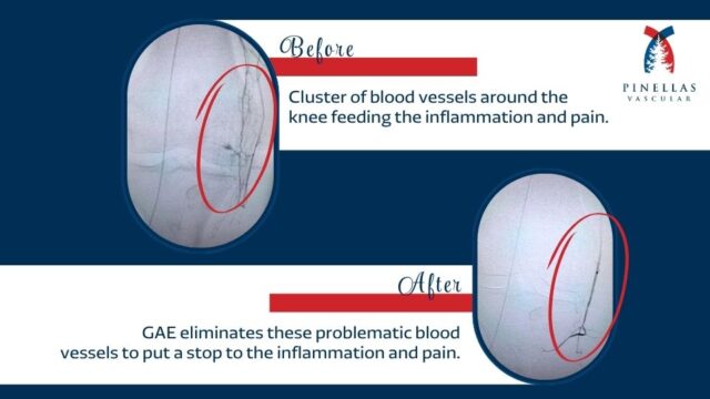 Treatment for Osteoarthritis Knee Pain St Pete FL - GAE